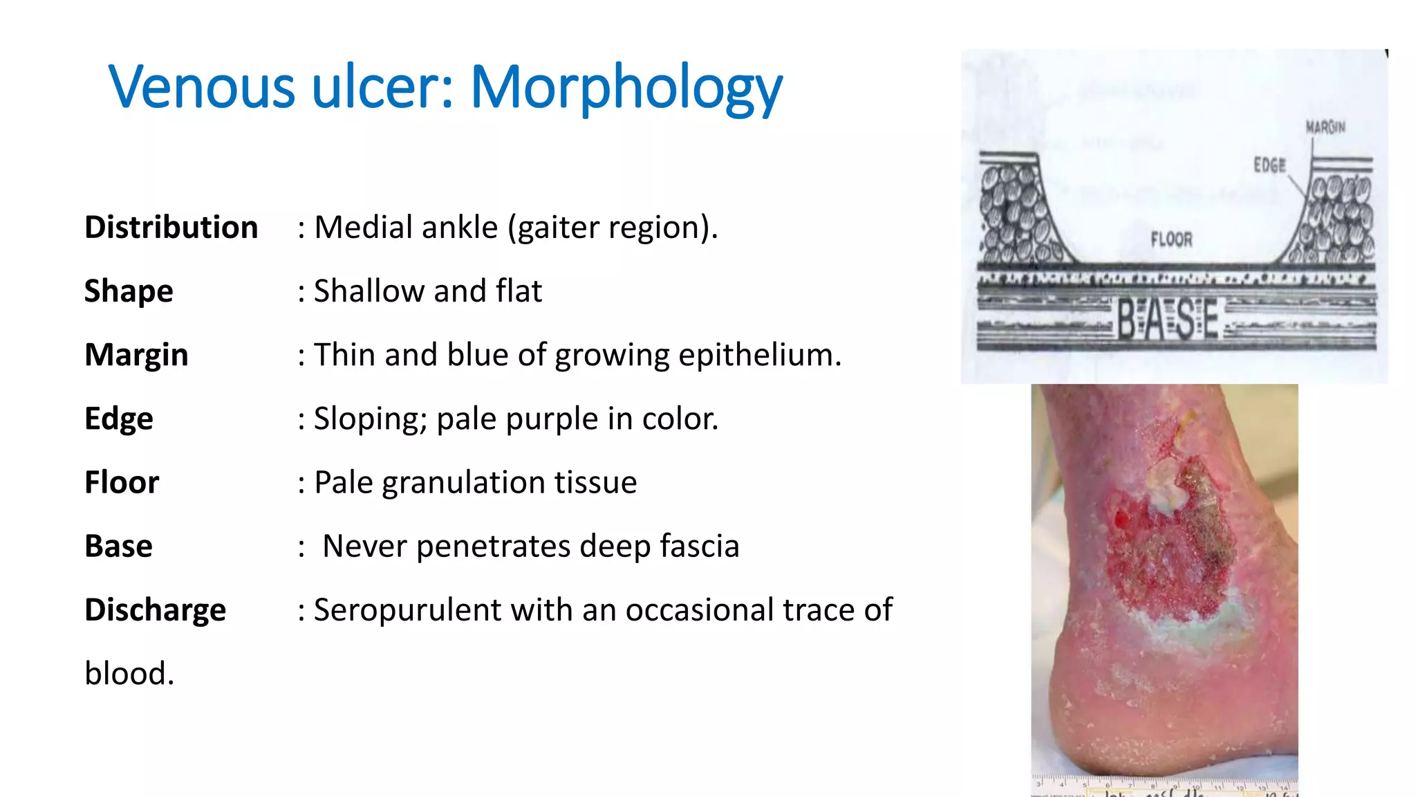 Venous ulcer | PPTX