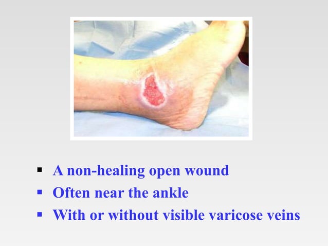 Venous Ulcers.pptx