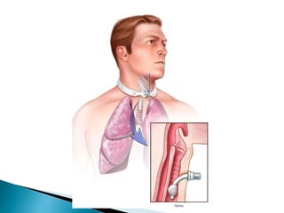 Vent and Tracheostomy | PPTX