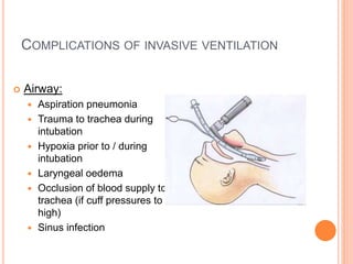 Ventilation mechanics and illustration and procedures | PPT