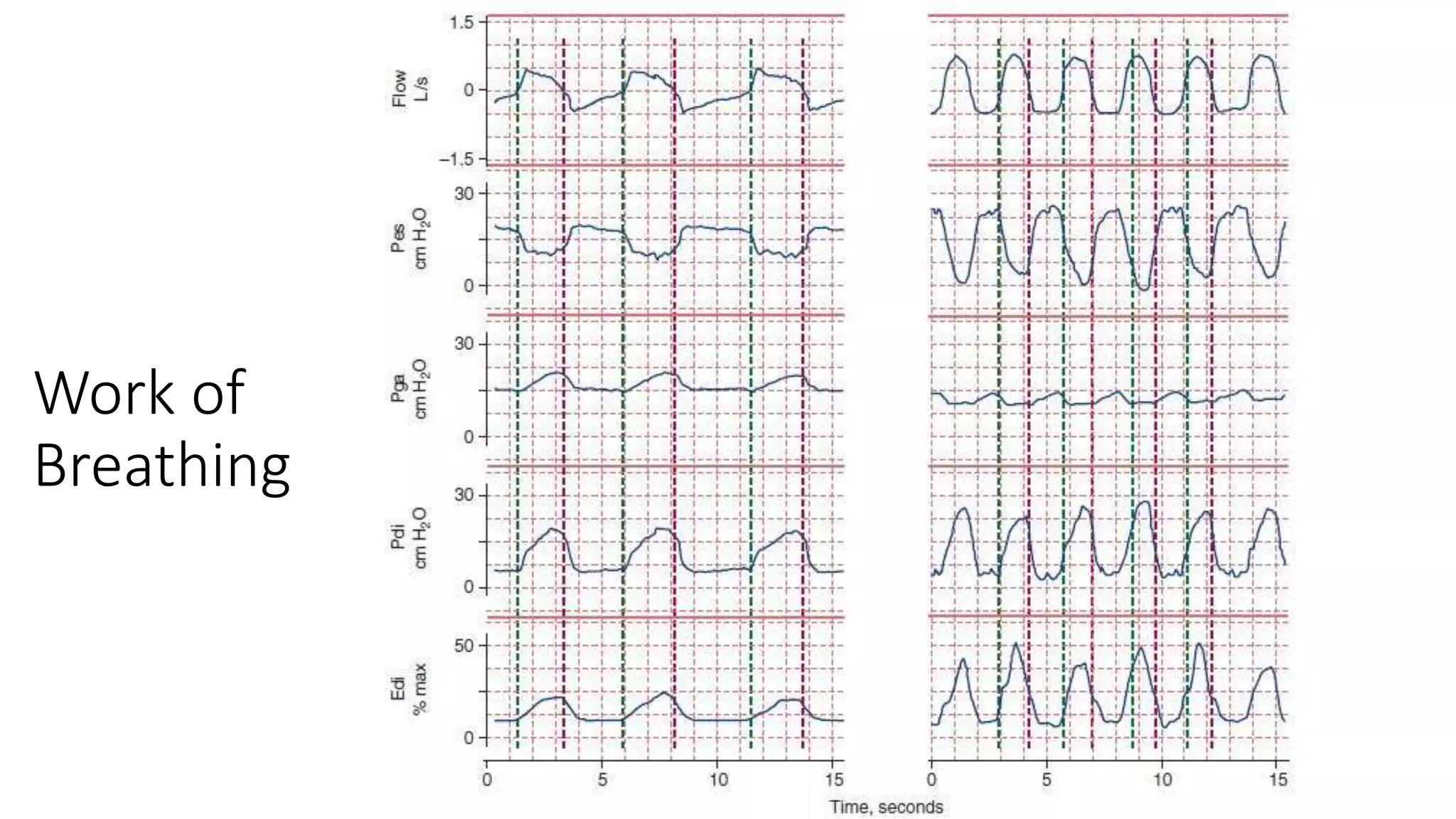 Ventilation 7 patient-ventilator dyssynchrony | PPTX