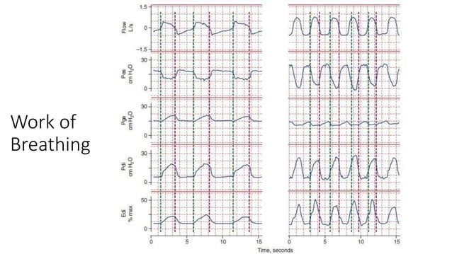 Ventilation 7 patient-ventilator dyssynchrony | PPTX