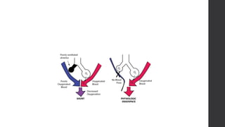 VENTILATION AND PERFUSION FOR NURSING ANATOMY | PPTX