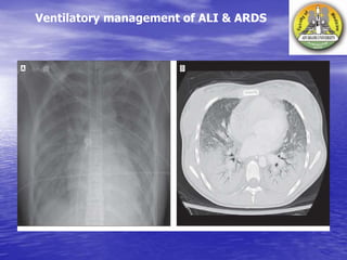 Ventilation in ARDS.ppt