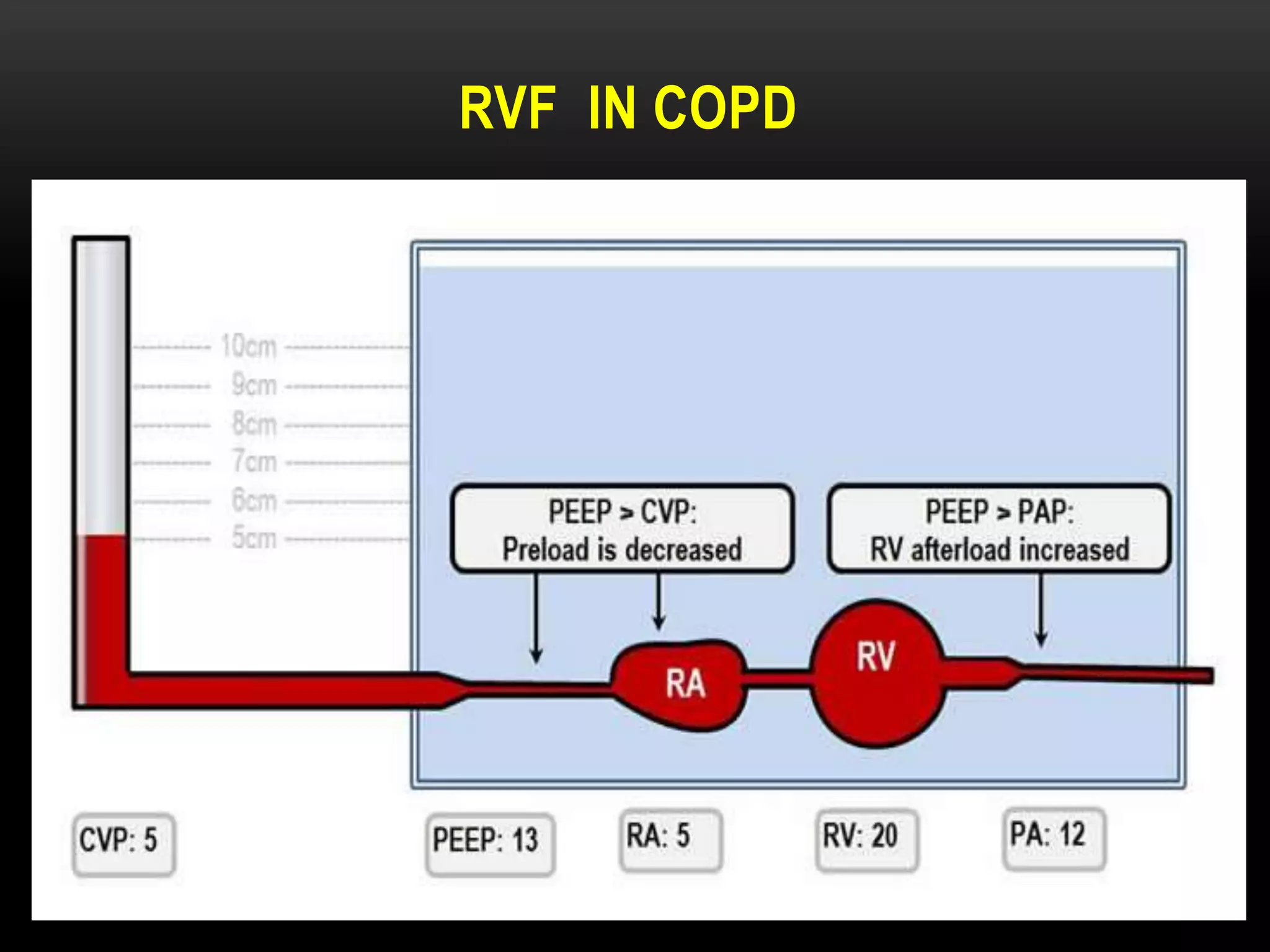 Ventilation Strategy in obstructive Lung disease | PPTX