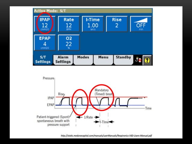 Ventilation Strategy in obstructive Lung disease | PPTX | Lung and ...