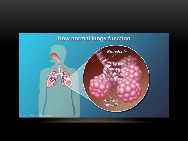 Ventilation Strategy in obstructive Lung disease | PPTX | Lung and ...