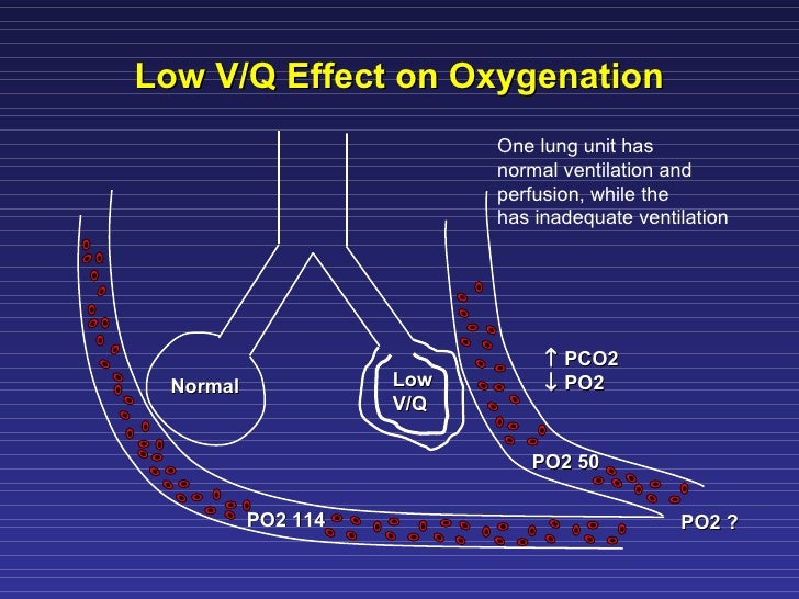 Ventilation Perfusion Matching