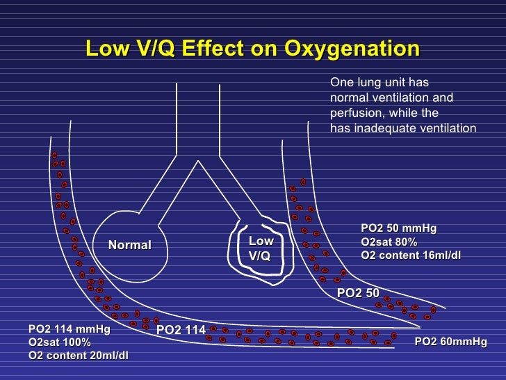 Ventilation Perfusion Matching