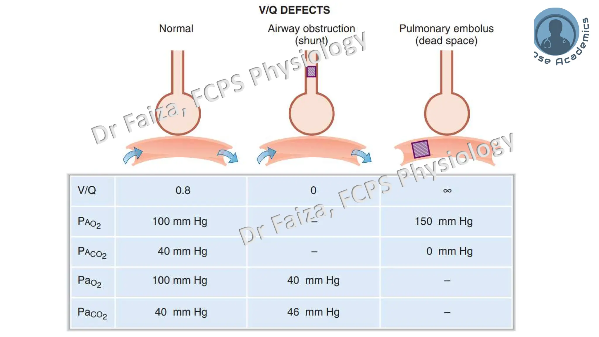 Ventilation Perfusion Ratio, Physiological dead space and physiological ...