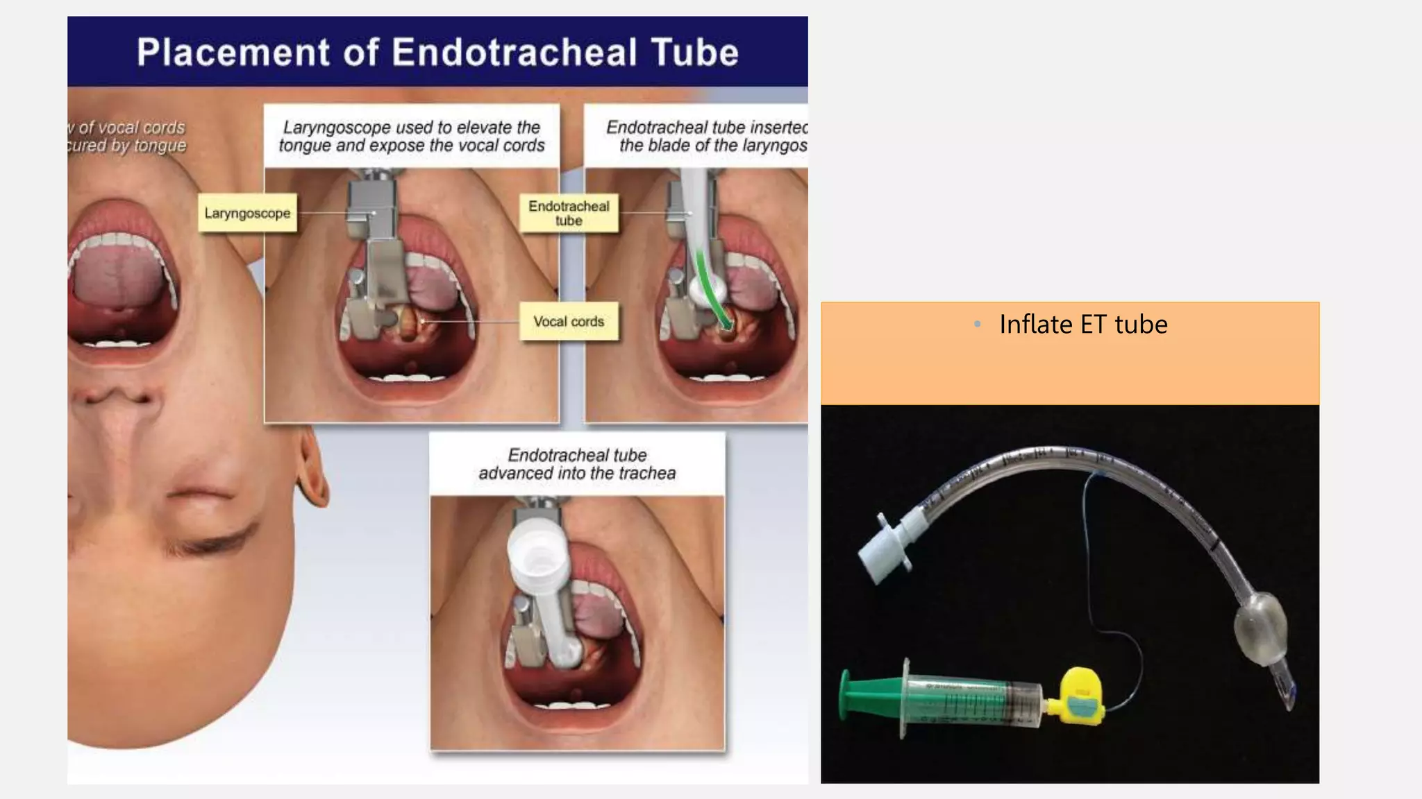 Intubation.pptx