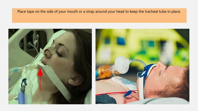 Intubation.pptx | First Aid | Injuries