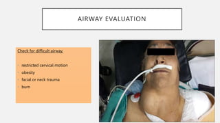 Intubation.pptx