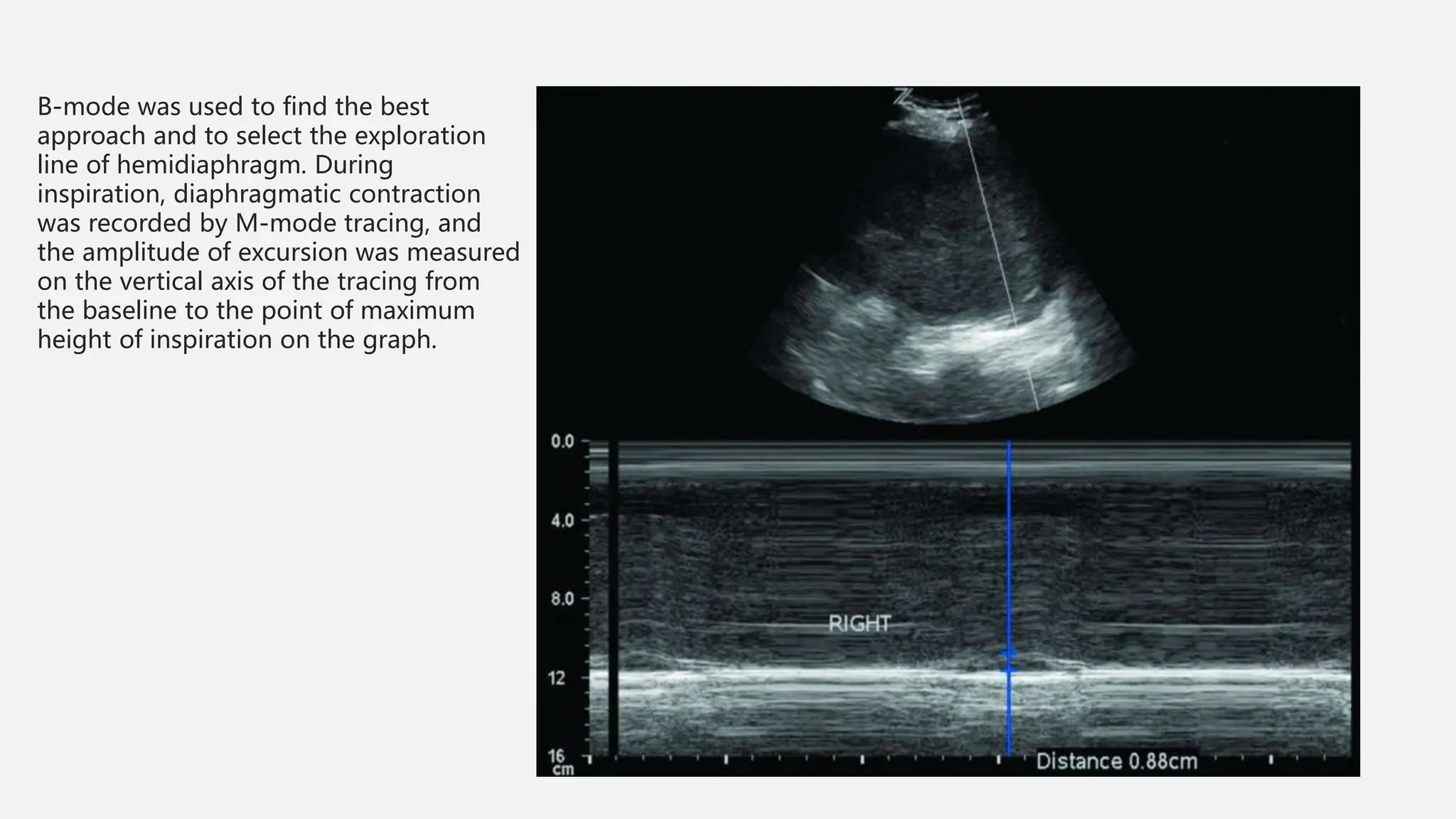 ventilator-induced diaphragmatic dysfunction.pptx