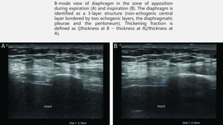 ventilator-induced diaphragmatic dysfunction.pptx