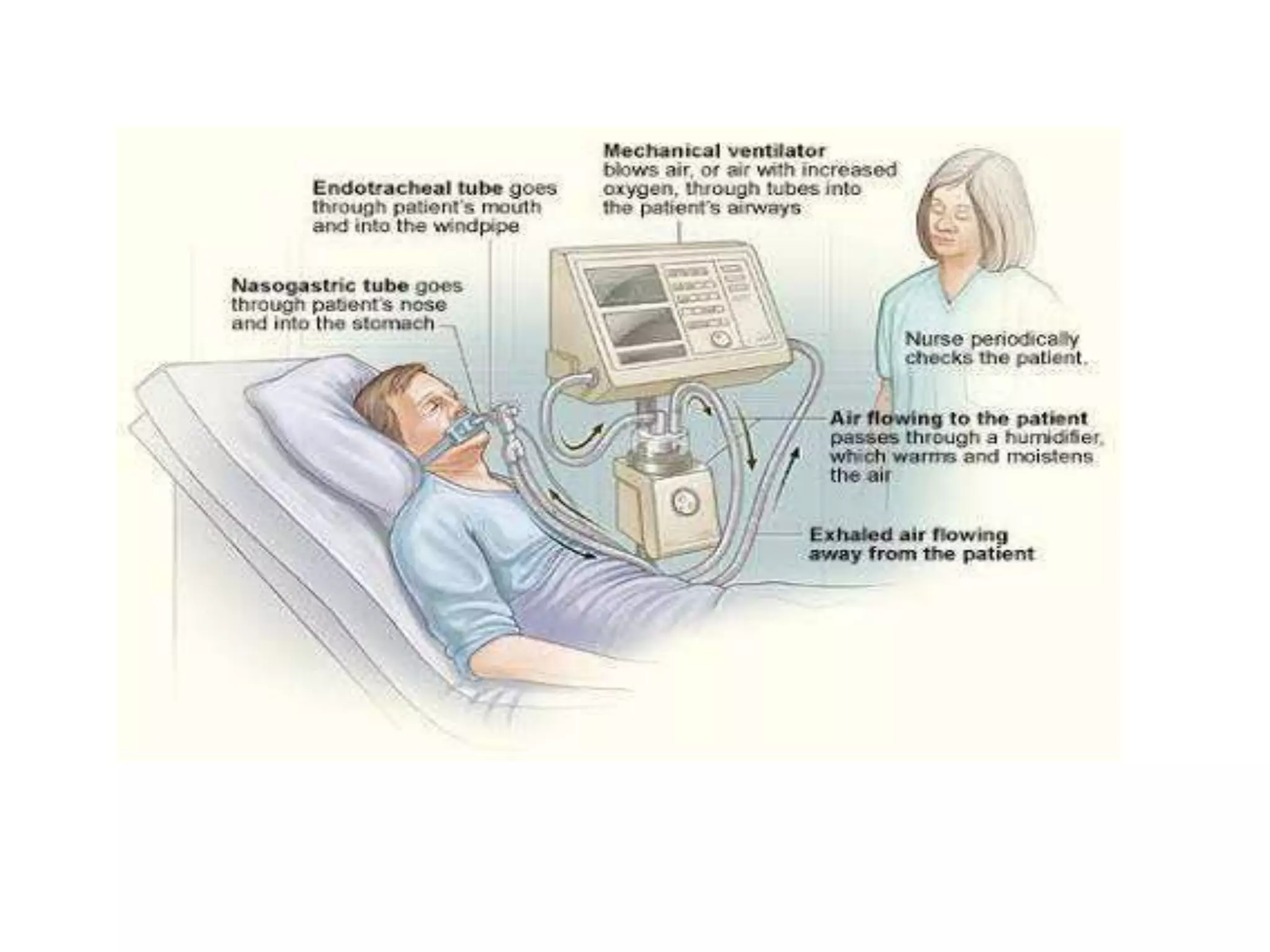 Ventilator | PPTX