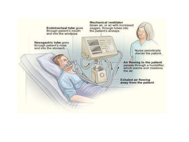 Ventilator | PPTX