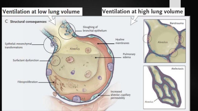 Ventilator associated lung injury
