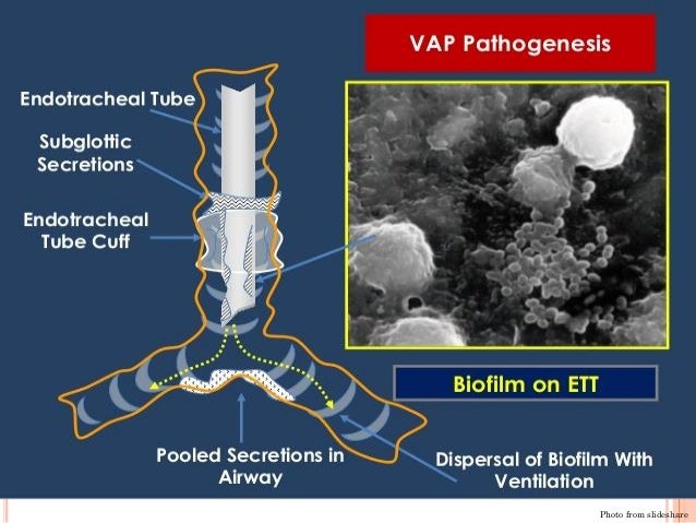 Ventilator Associated Pneumonia (VAP) or Hospital Acquired Pneumonia