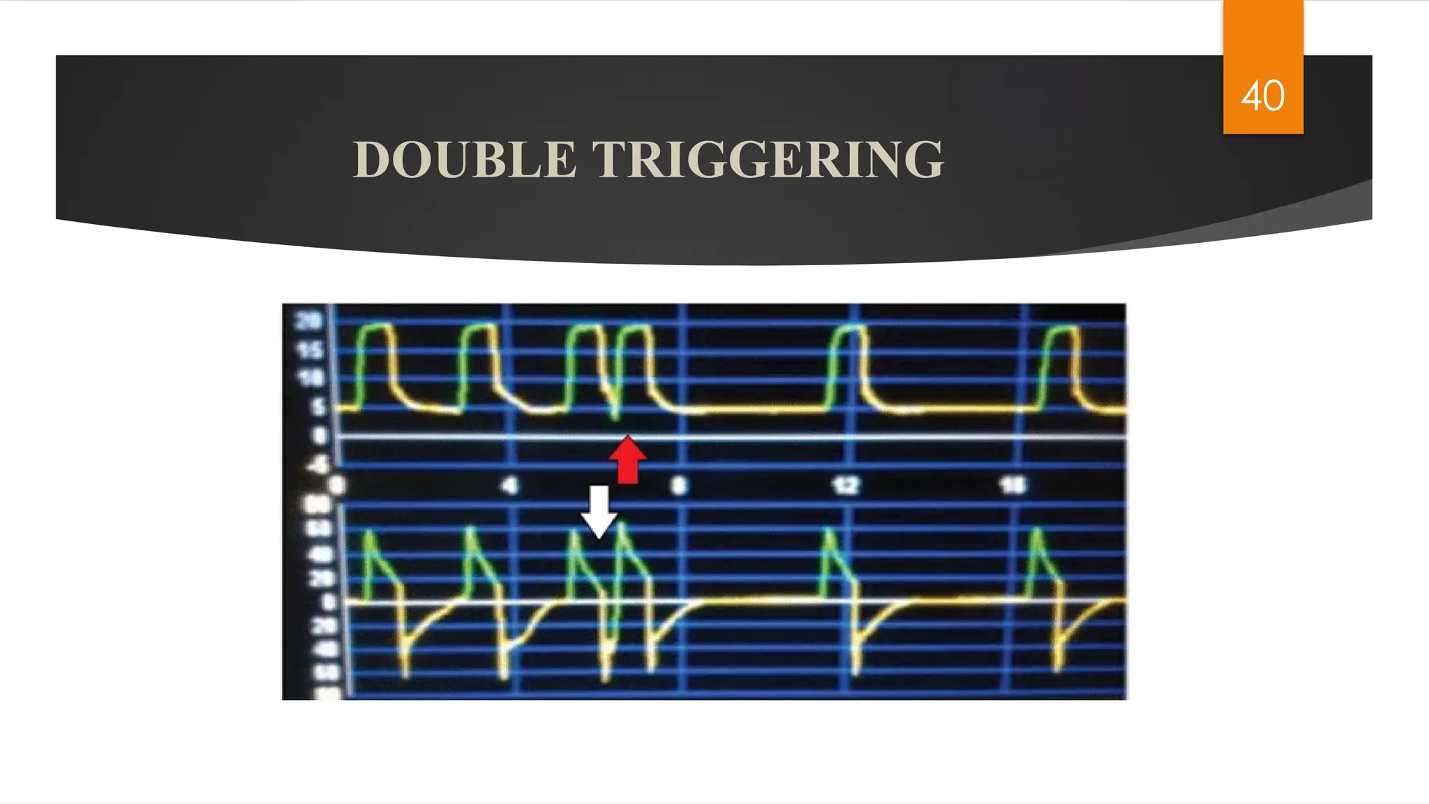 VENTILATOR GRAPHICS,Purposes of monitoring graphics | PPTX
