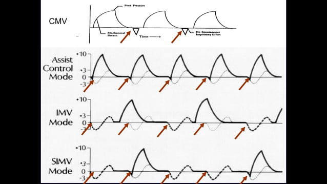 ventilator graphics in anesthesia machinepptx | PPT