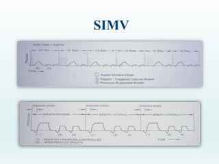 Ventilator .pptx