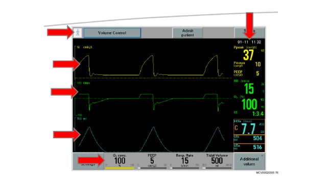 Ventilator setting | PDF | Lung and Respiratory Health | Diseases and ...