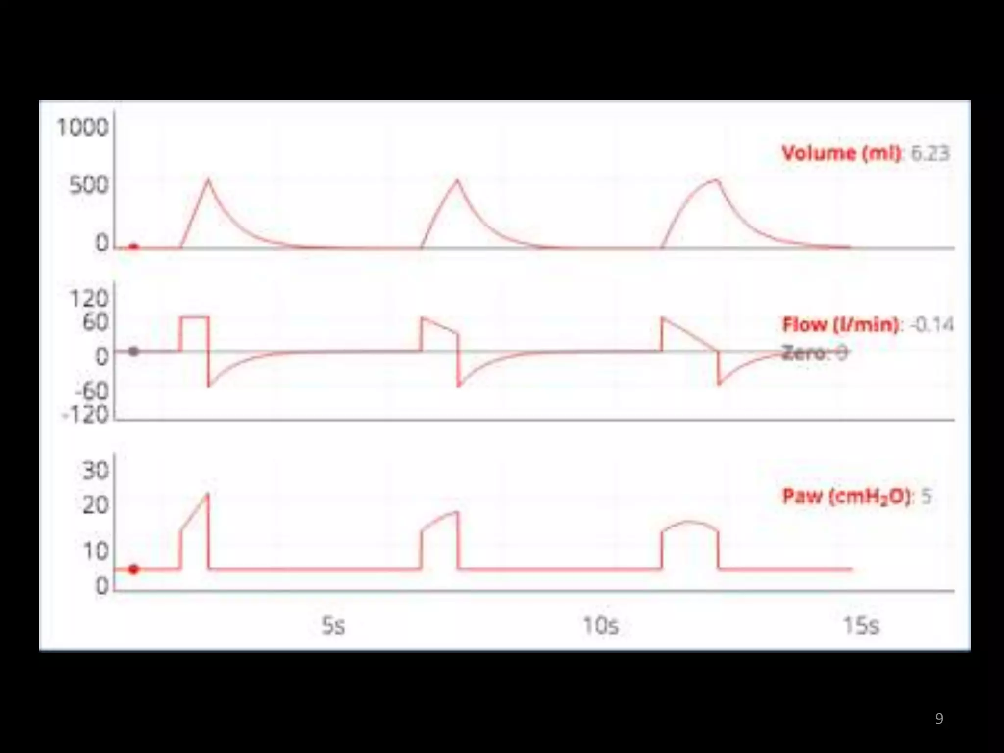 Ventilator waveforms | PPTX