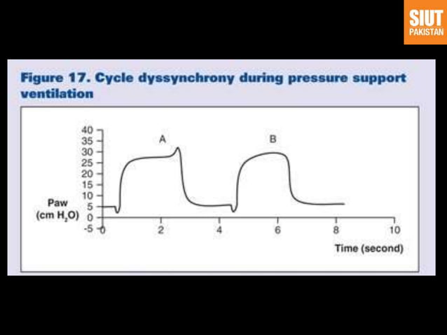 Ventilator waveforms | PPTX