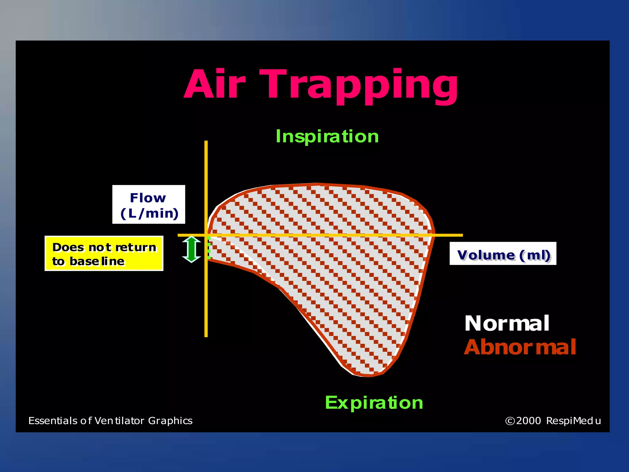 ventilator waveforms Dr Sanjay Chugh.pptx