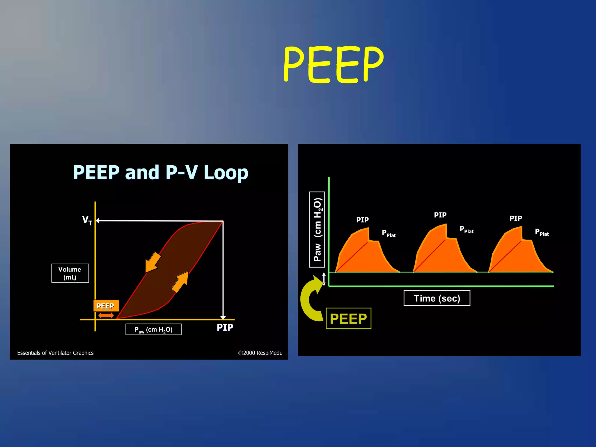 ventilator waveforms Dr Sanjay Chugh.pptx