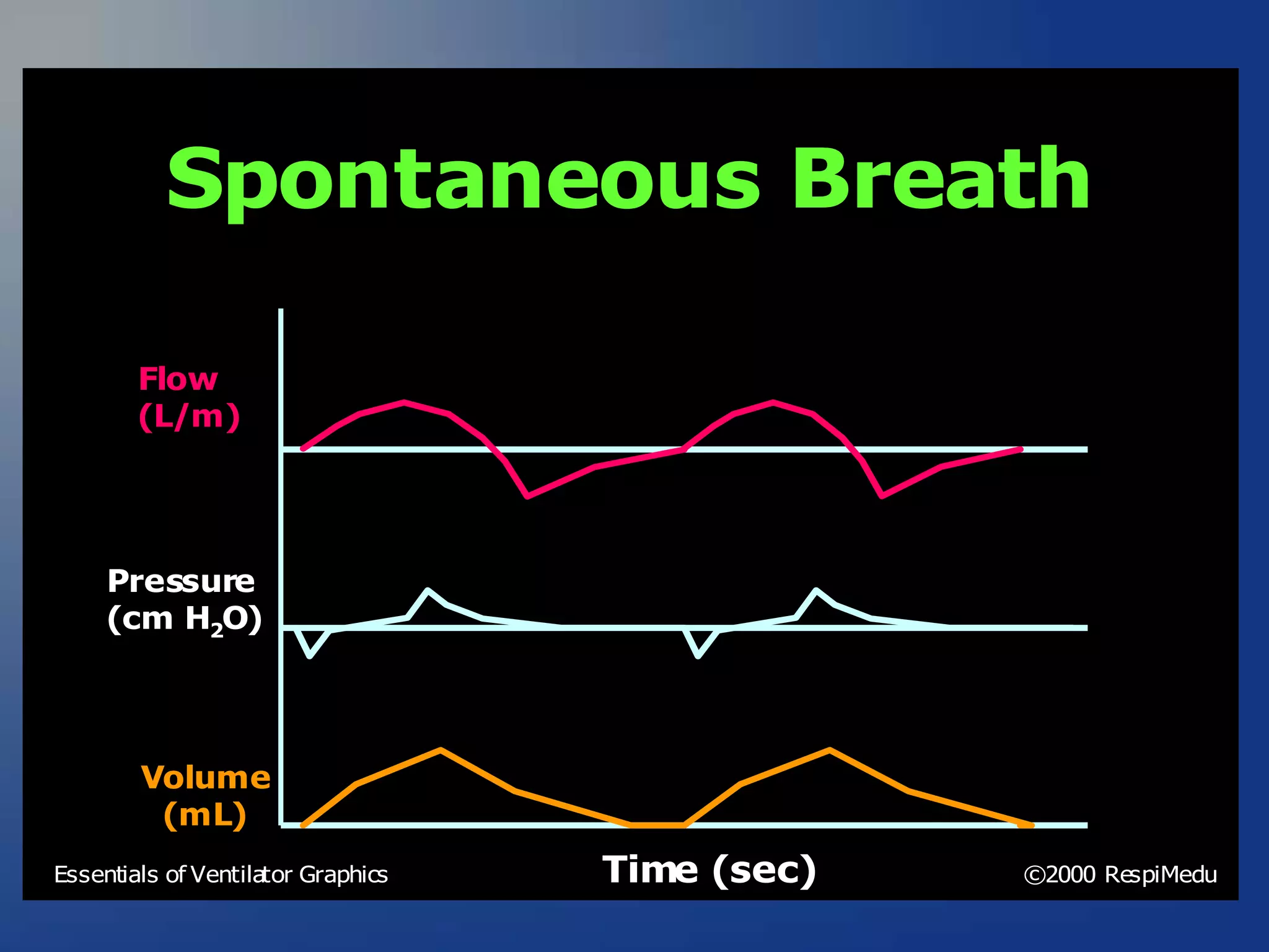 ventilator waveforms Dr Sanjay Chugh.pptx