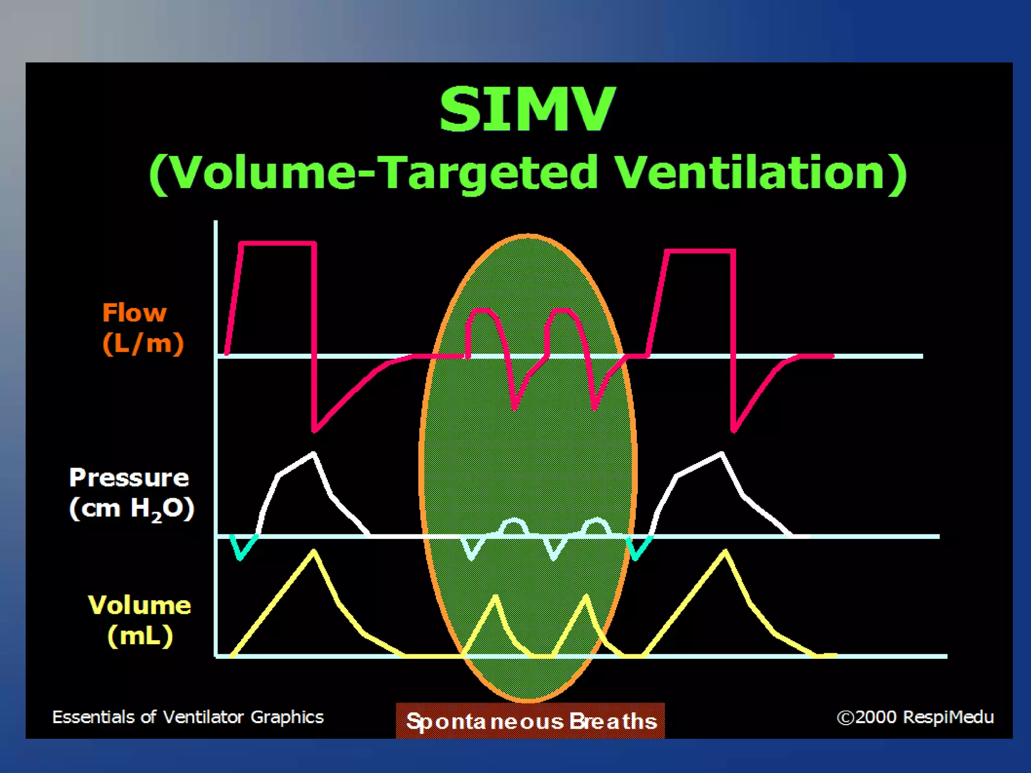 ventilator waveforms Dr Sanjay Chugh.pptx