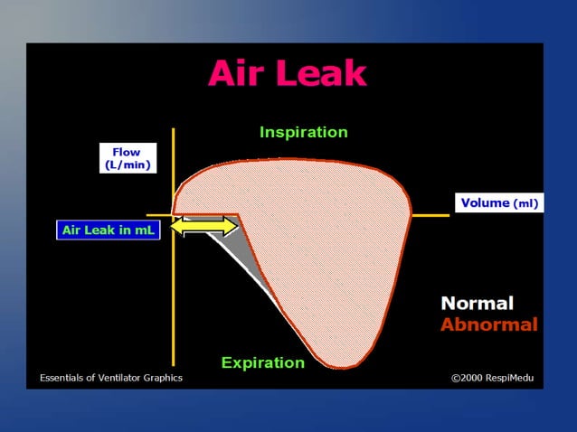 ventilator waveforms Dr Sanjay Chugh.pptx | Lung and Respiratory Health ...