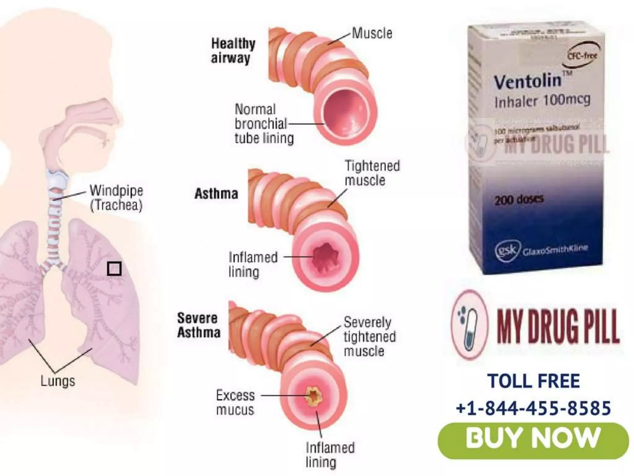 Ventolin Albuterol Inhalers | PPTX