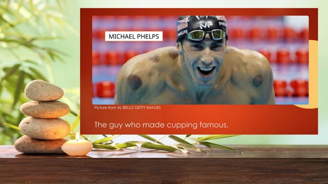 VENTOSA CUPPING THERAPY wellness massage.pptx | First Aid | Injuries