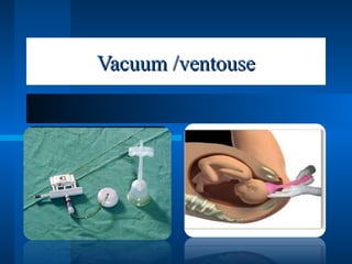 Ventose and forceps delivery for undergraduate | PPT