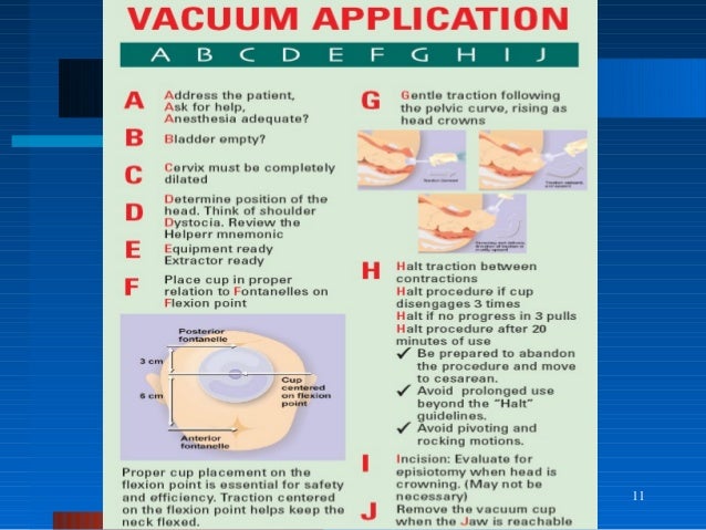 Ventose and forceps delivery for undergraduate