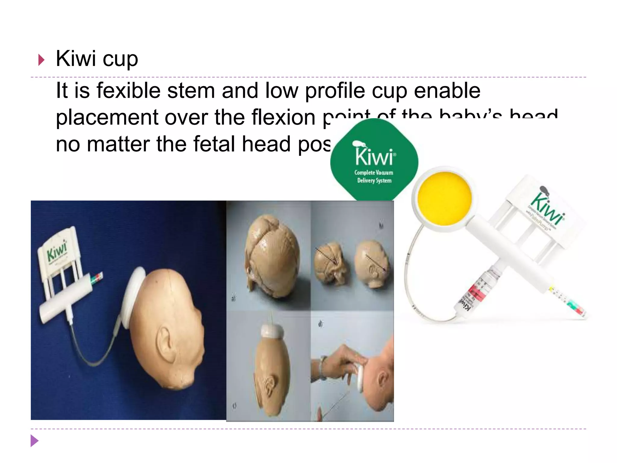 Ventouse delivery | PPTX