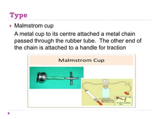 Ventouse delivery | PPTX