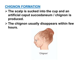 Ventouse or vaccum delivery | PPT