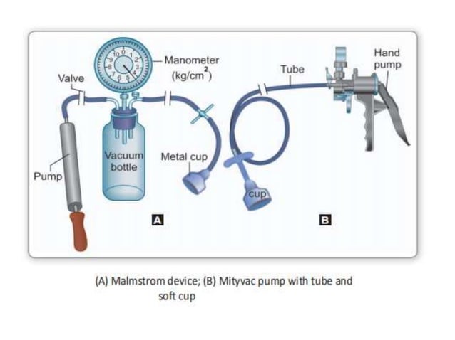 Ventouse or vaccum delivery | PPT | Pregnancy | Reproductive Health