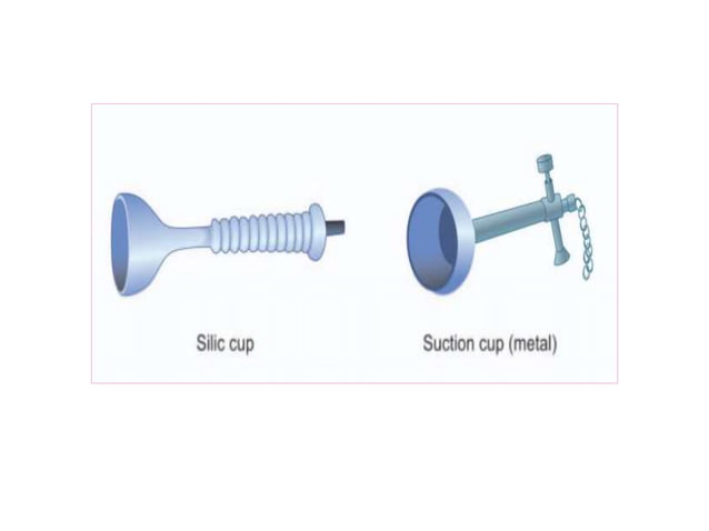 Ventouse or vaccum delivery | PPT | Pregnancy | Reproductive Health