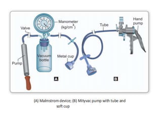 Ventouse or vaccum delivery | PPT