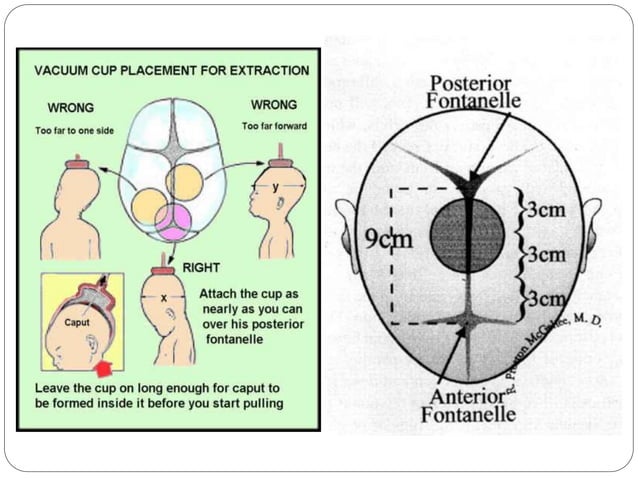 Ventouse in obgyn | PPTX | Pregnancy | Reproductive Health