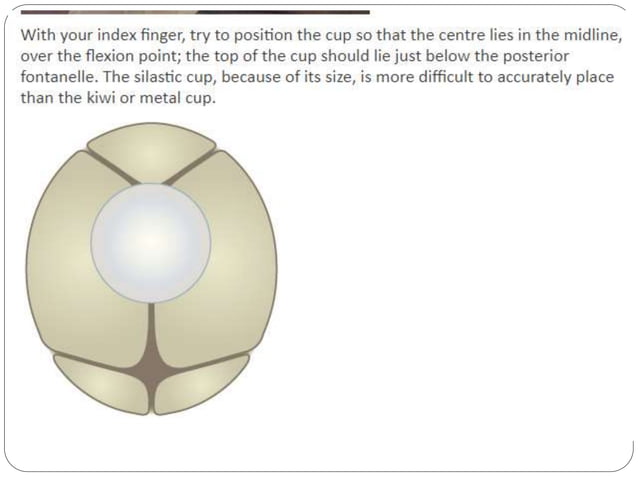 Ventouse in obgyn | PPTX | Pregnancy | Reproductive Health