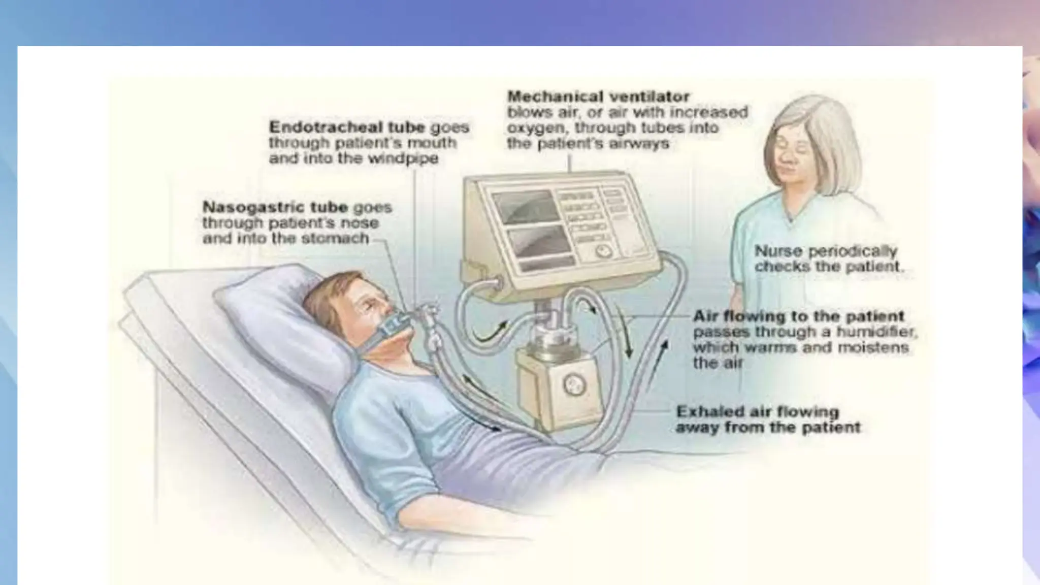Mechanical ventilation to understand basics of mechanical ventilation ...