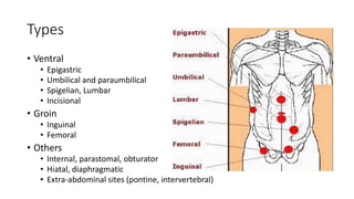 VENTRAL AND GROIN HERNIA BSc 3.pptx