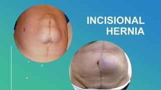 Ventral and incisional hernias and management.pptx