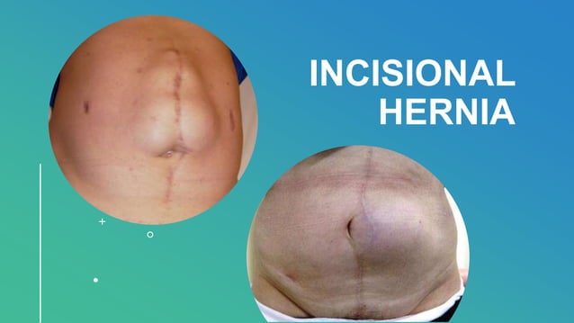 Ventral and incisional hernias and management.pptx | Death, Injury, or ...